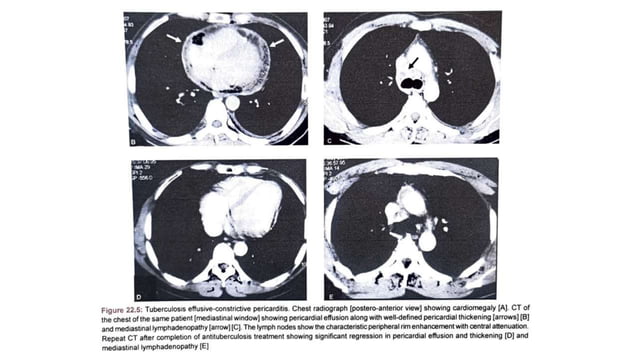TB Pericarditis.pptx | Heart and Cardiovascular Diseases | Diseases and ...