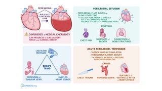 TB Pericarditis.pptx