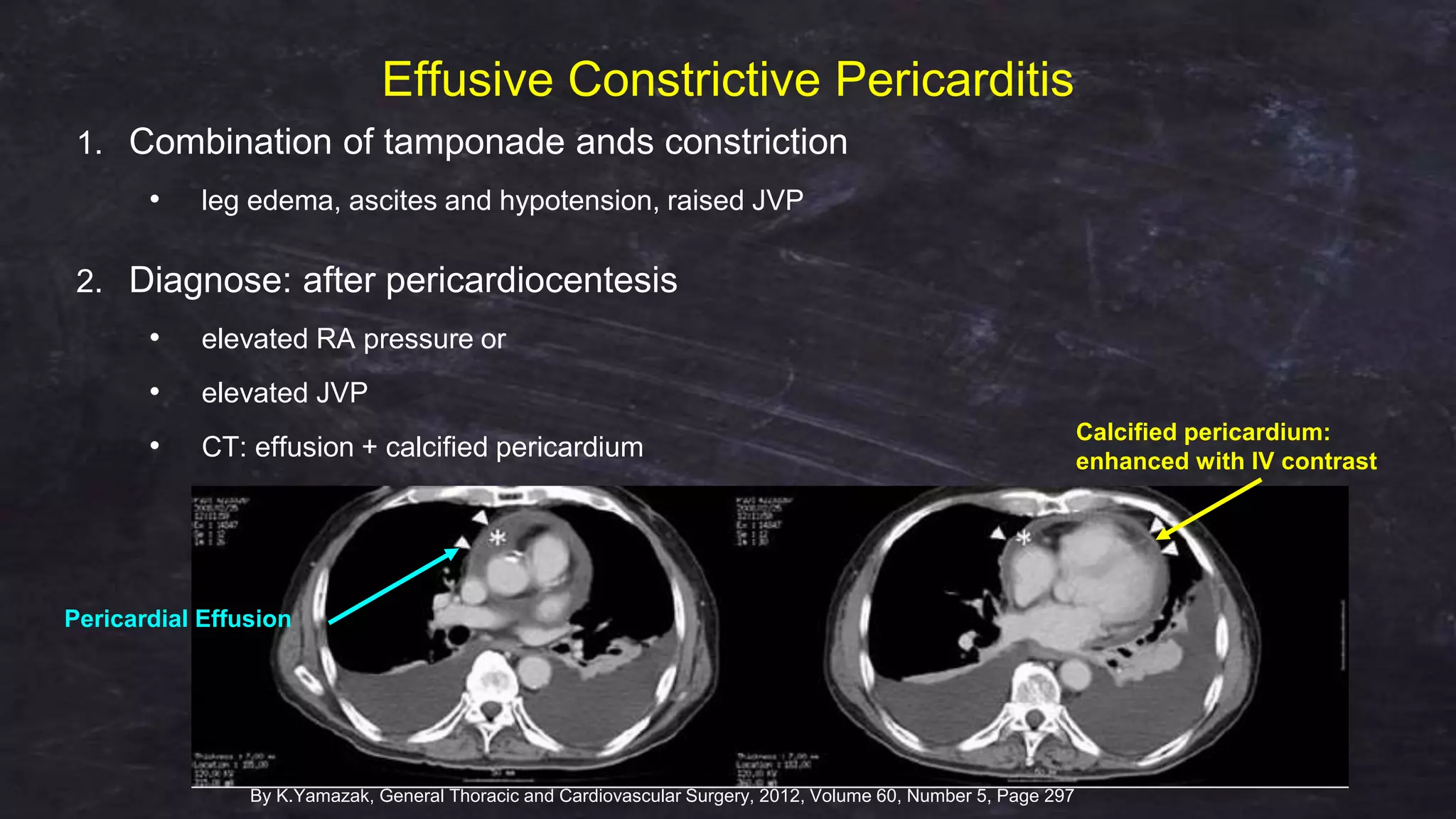 Tb Pericarditis | PPTX
