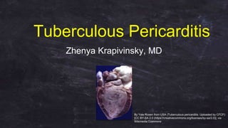 Tb Pericarditis | PPTX