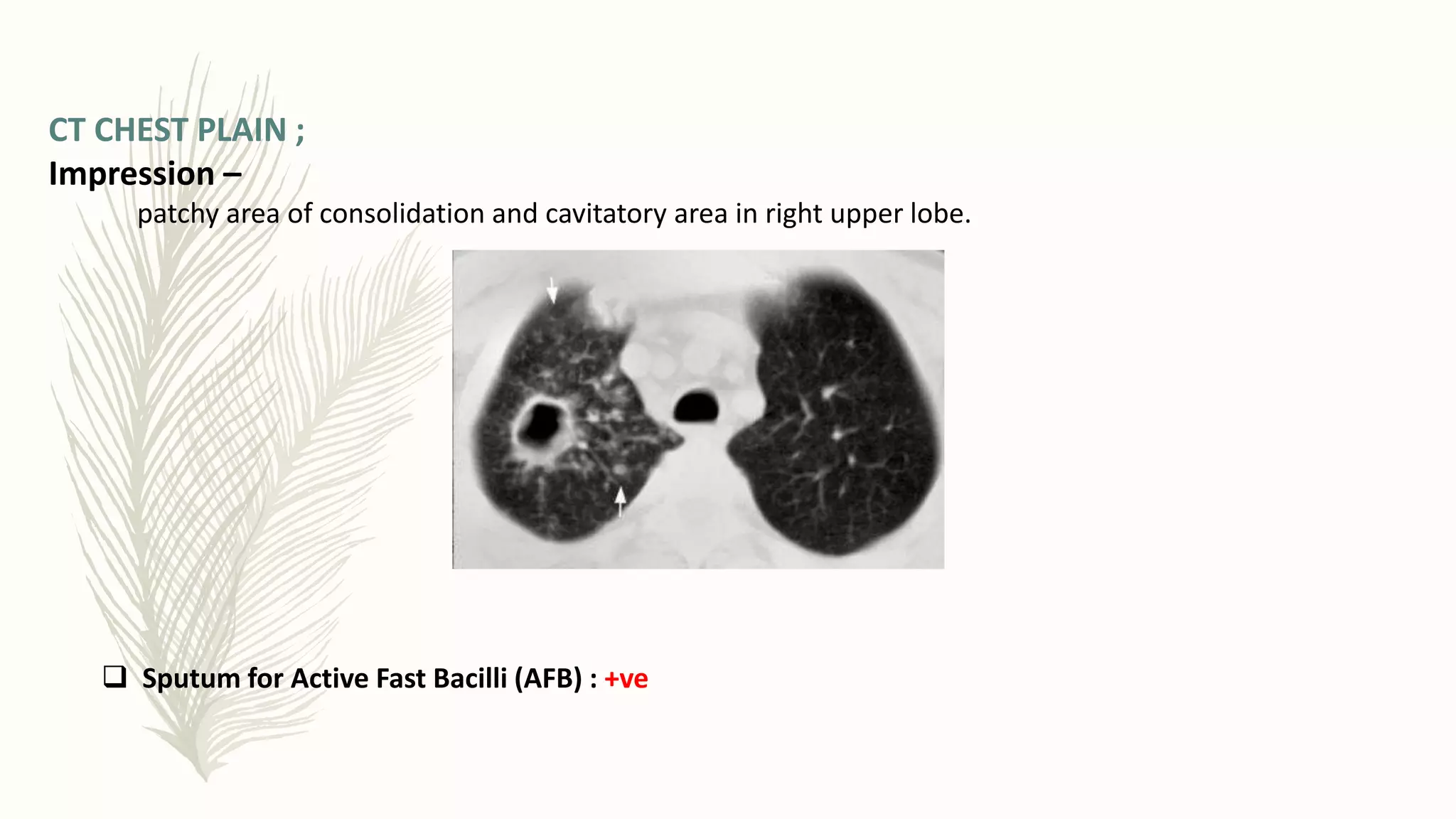 case presentation on PULMONARY TUBERCULOSIS | PPTX