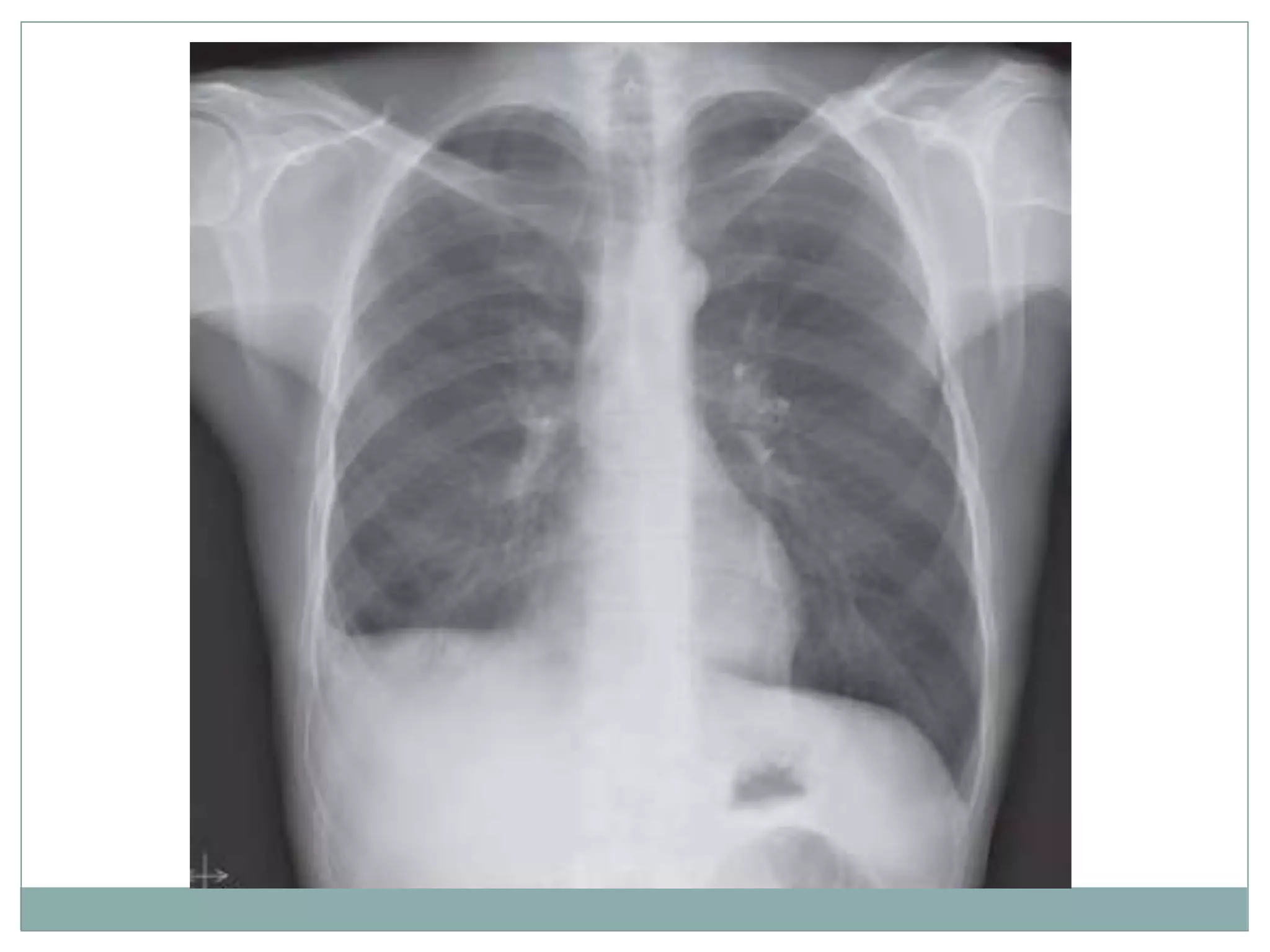Role of Radiology in Pulmonary Tuberculosis | PPTX