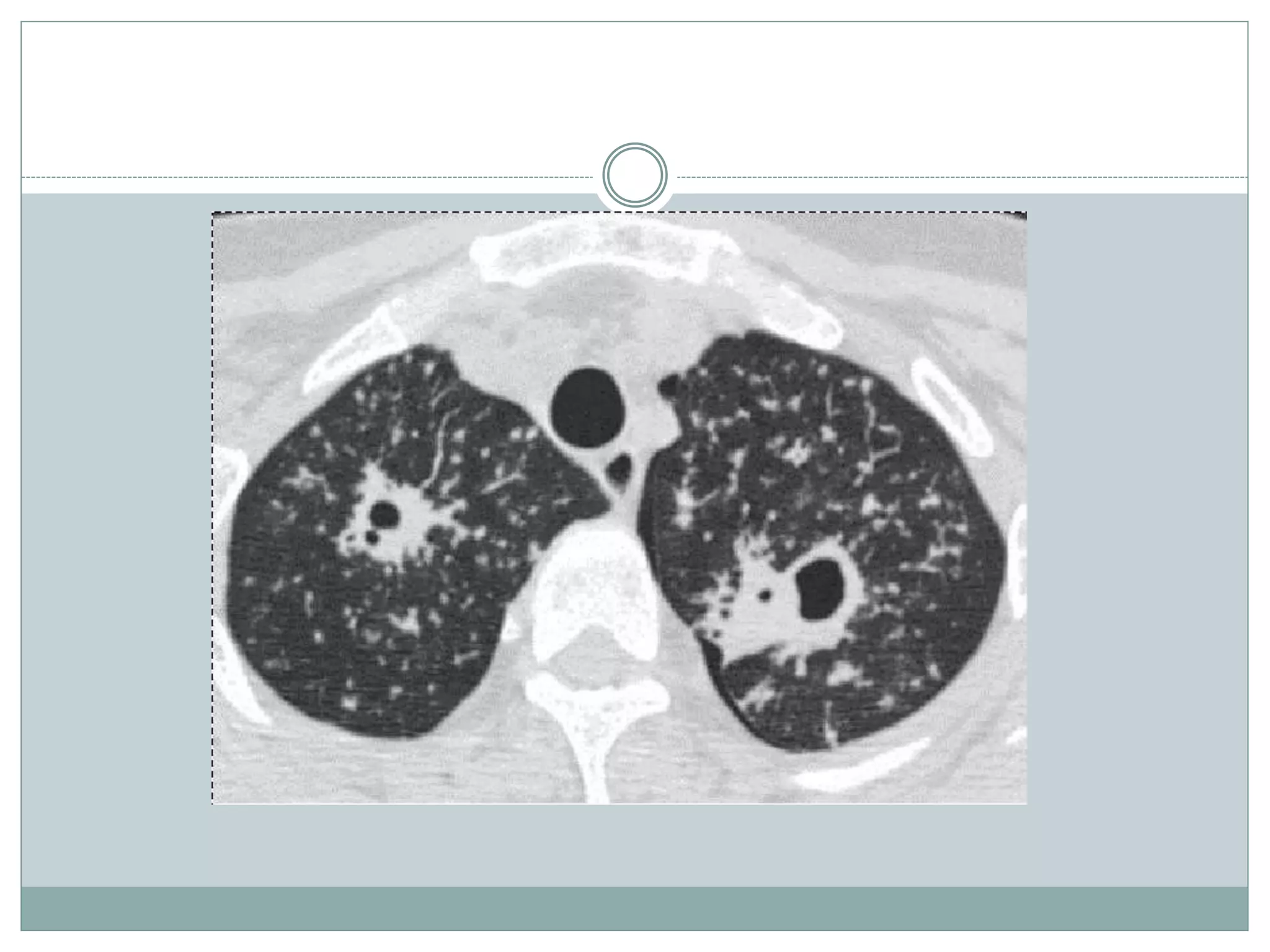 Role of Radiology in Pulmonary Tuberculosis | PPTX