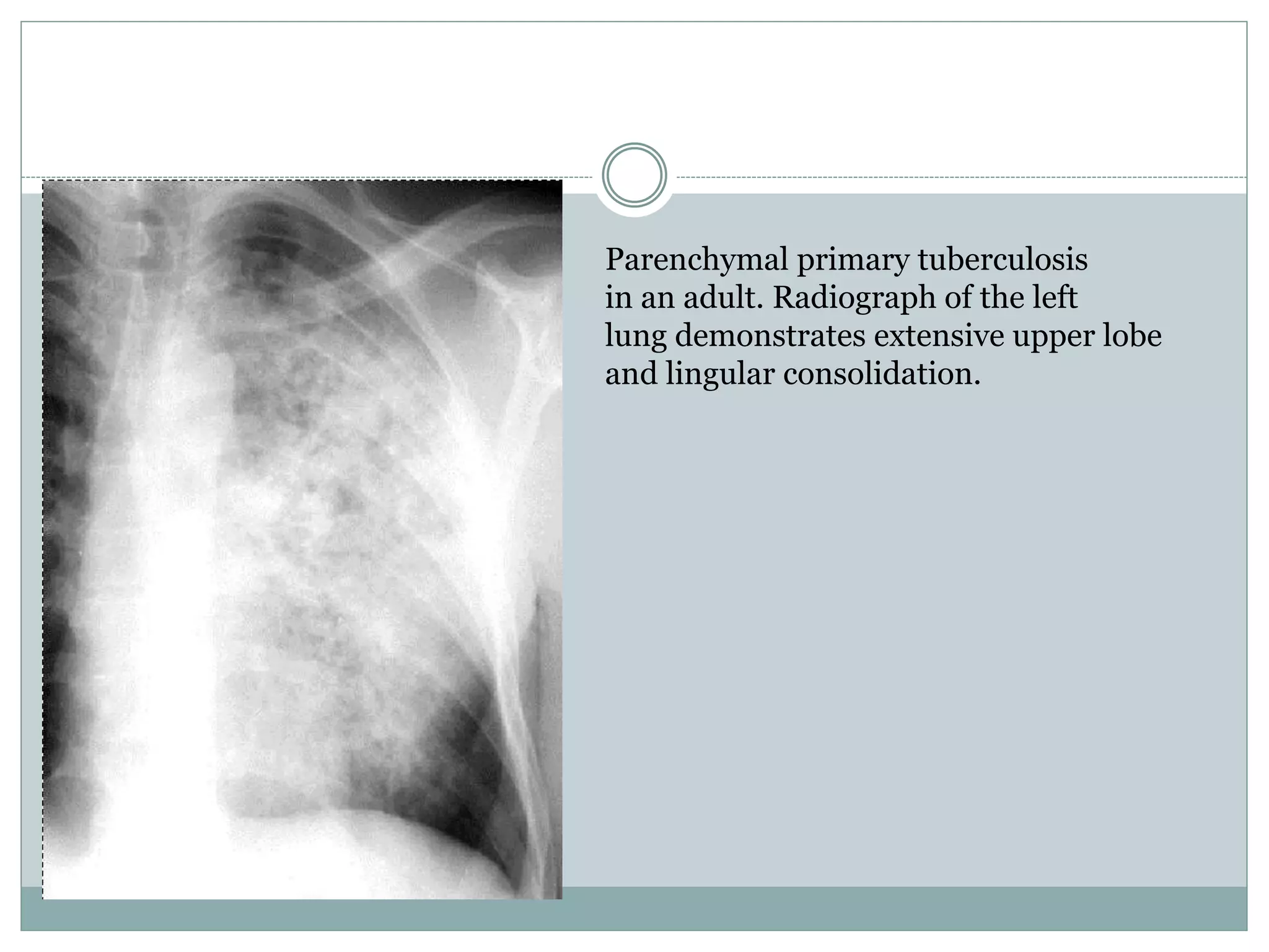 Role Of Radiology In Pulmonary Tuberculosis Pptx