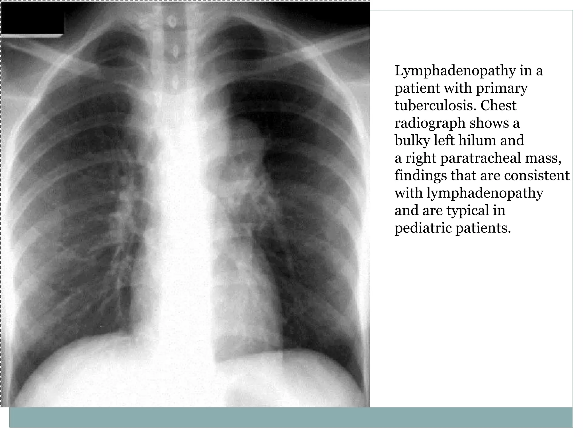 Role of Radiology in Pulmonary Tuberculosis | PPTX