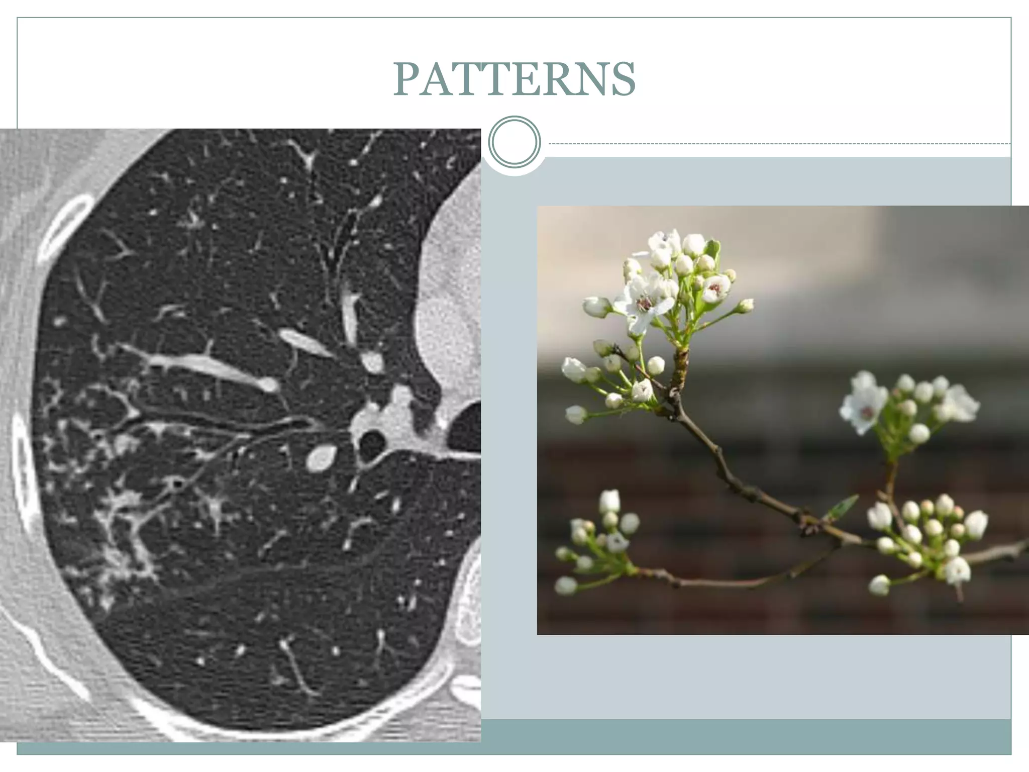 Role of Radiology in Pulmonary Tuberculosis | PPTX