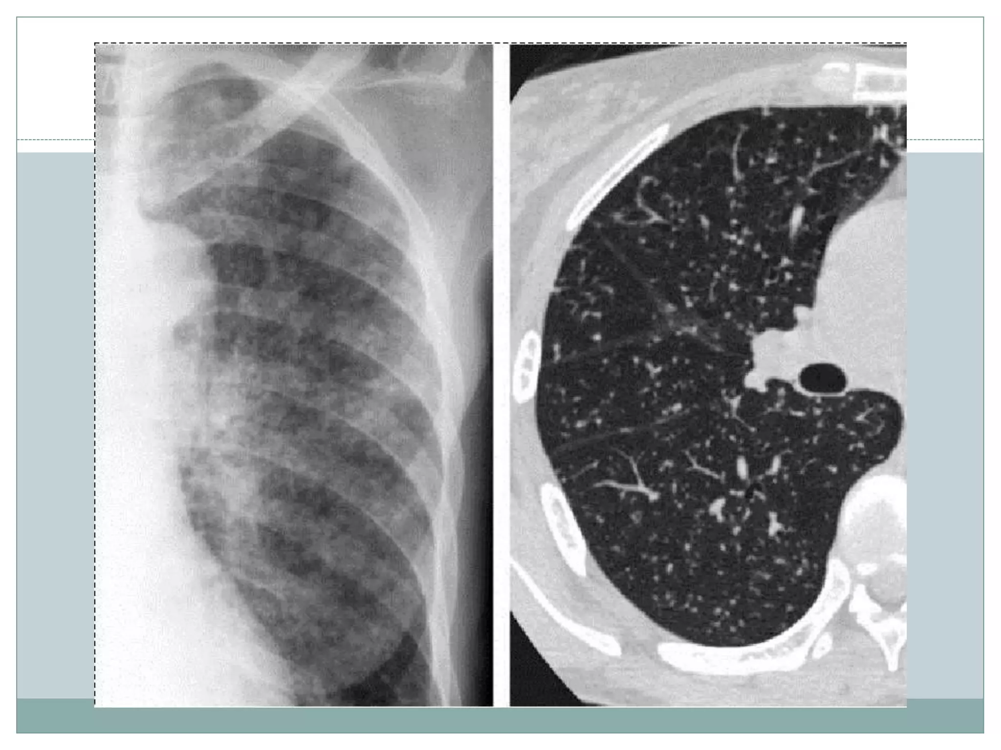Role of Radiology in Pulmonary Tuberculosis | PPTX