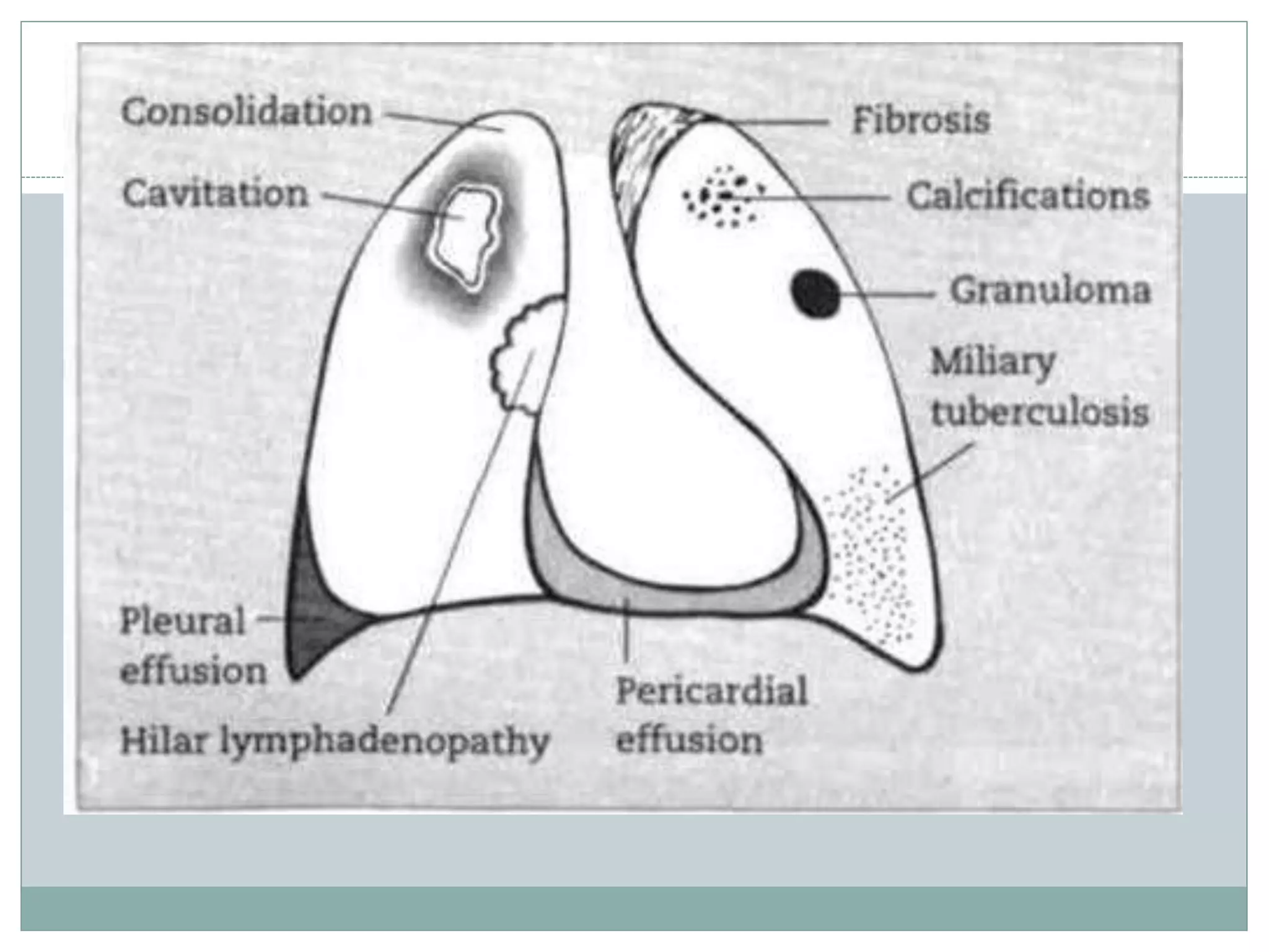 Role of Radiology in Pulmonary Tuberculosis | PPTX