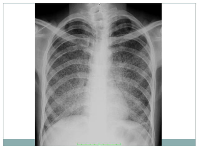 Role of Radiology in Pulmonary Tuberculosis | PPTX