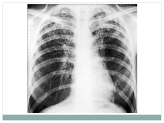 Role of Radiology in Pulmonary Tuberculosis | PPTX