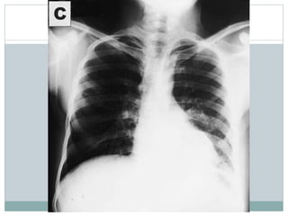 Role of Radiology in Pulmonary Tuberculosis | PPTX