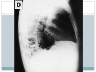Role of Radiology in Pulmonary Tuberculosis | PPTX