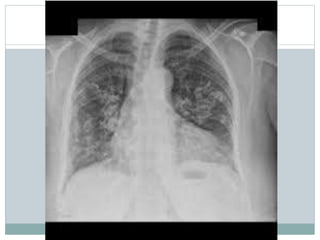 Role of Radiology in Pulmonary Tuberculosis | PPTX
