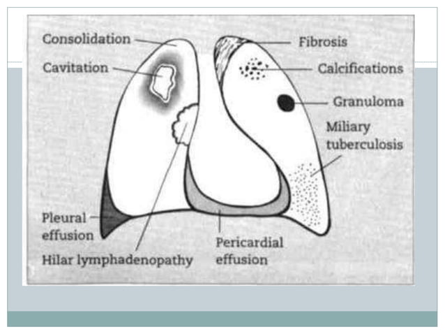 Role of Radiology in Pulmonary Tuberculosis | PPTX