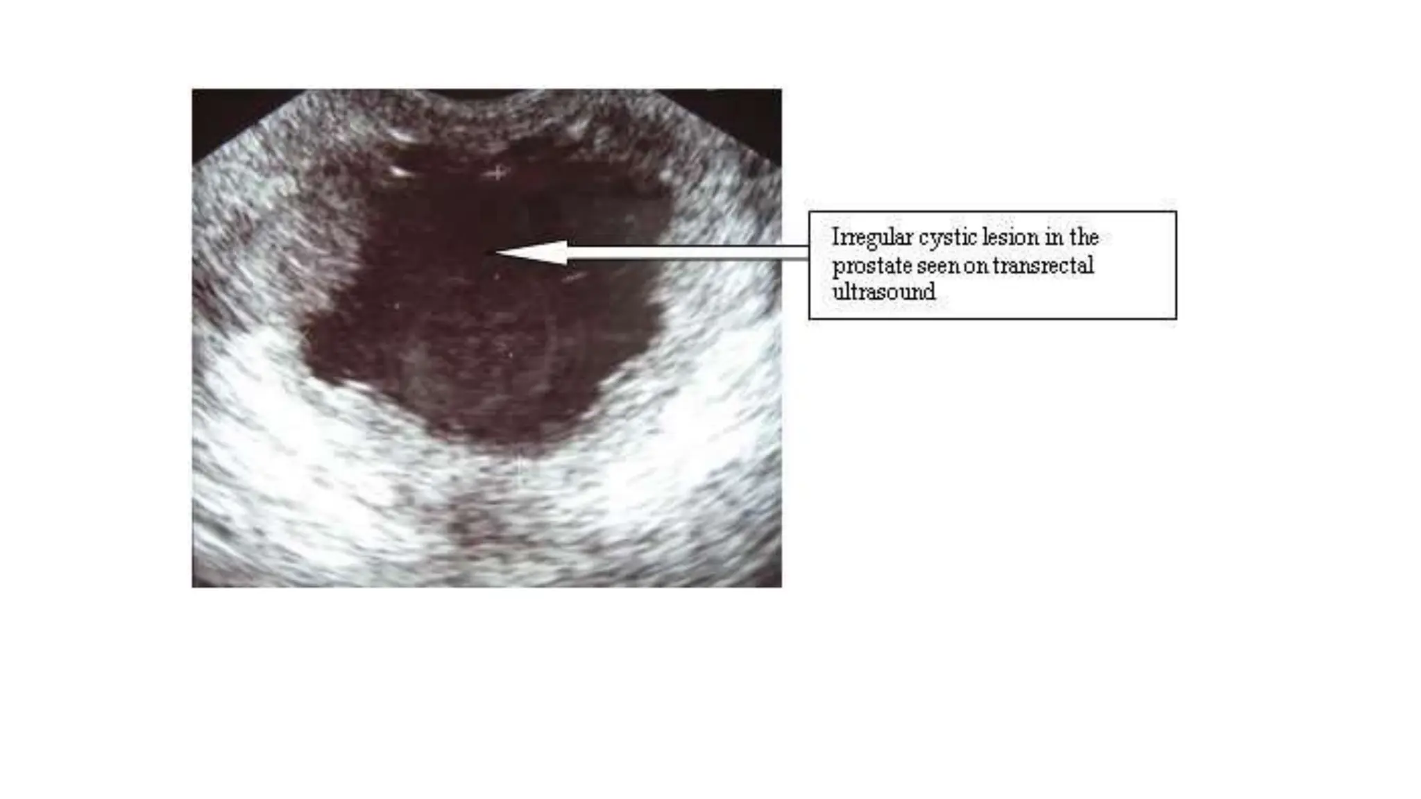 TB Prostate,Prostatitis,Prostate Abscess | PPT