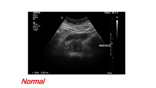TB Prostate,Prostatitis,Prostate Abscess | PPTX