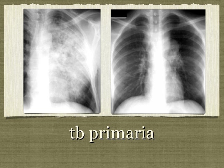 Tuberculosis pulmonar