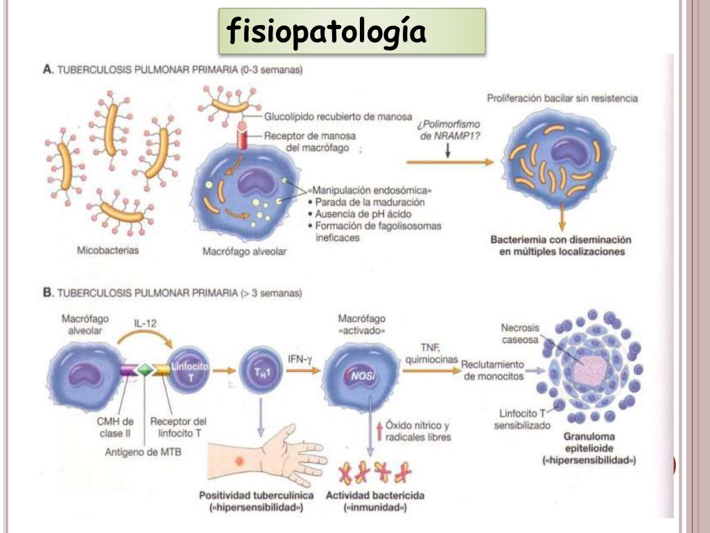 tuberculosis pulmonar
