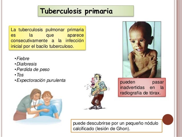 tuberculosis pulmonar
