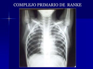 TB pulmonar.ppt