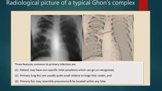 PEDIATRIC TB GUIDELINES RNTCP 2019 BY DR.ROHITH | PPTX