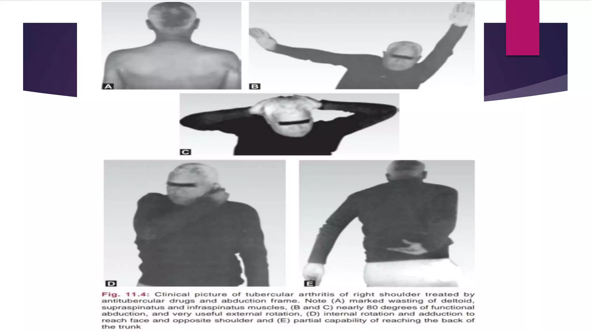 TB shoulder,elbow,wrist,short tubular bones(fingers,toes) | PPTX