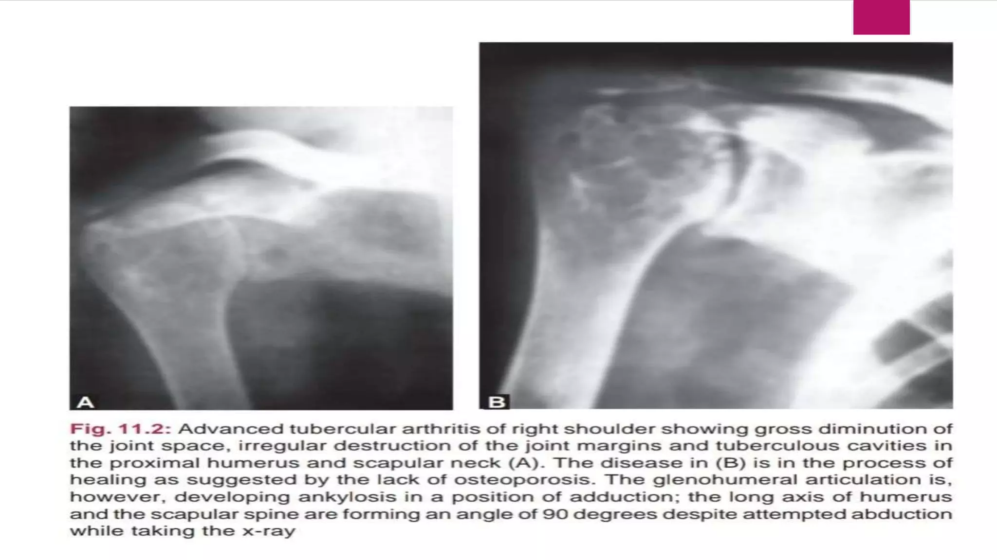 TB shoulder,elbow,wrist,short tubular bones(fingers,toes) | PPTX
