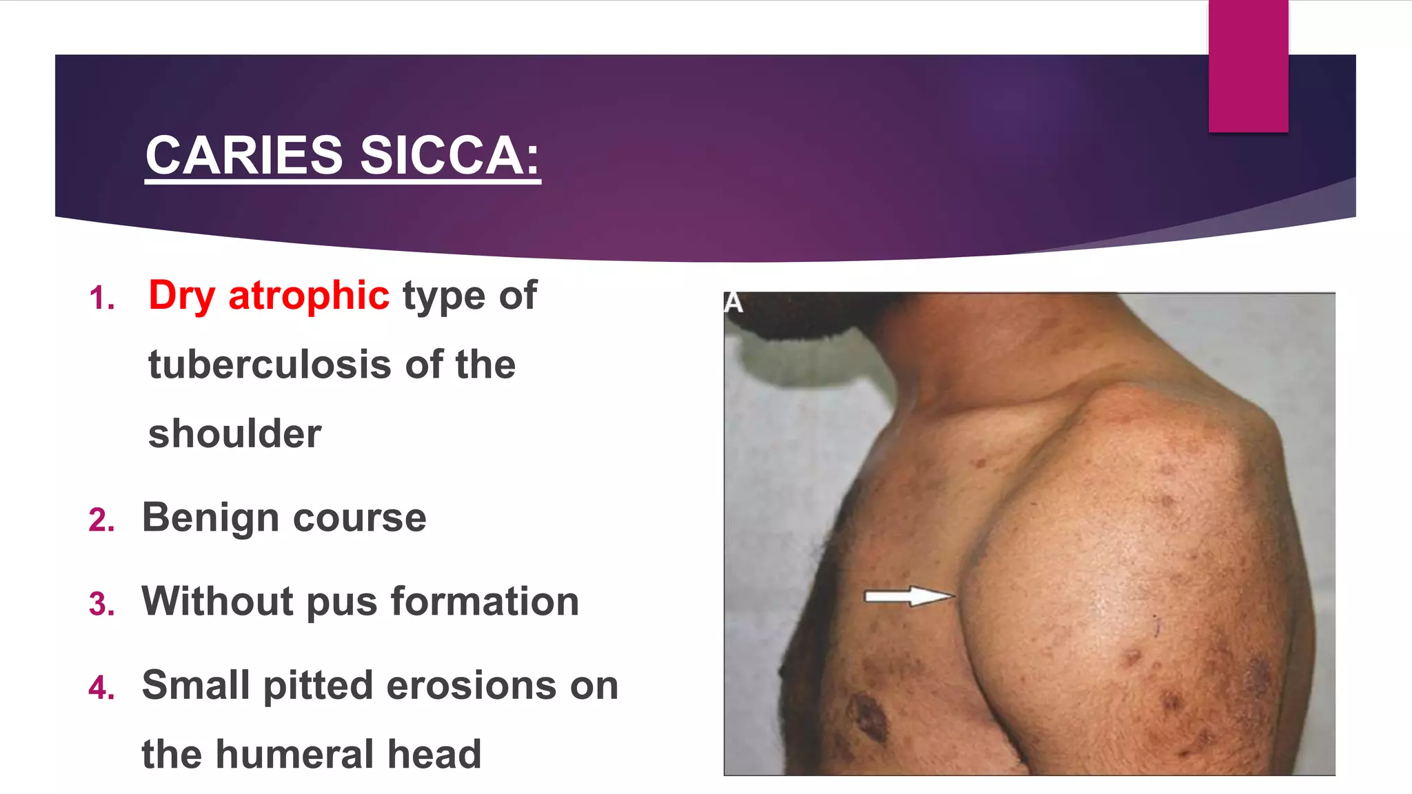 TB shoulder,elbow,wrist,short tubular bones(fingers,toes) | PPTX