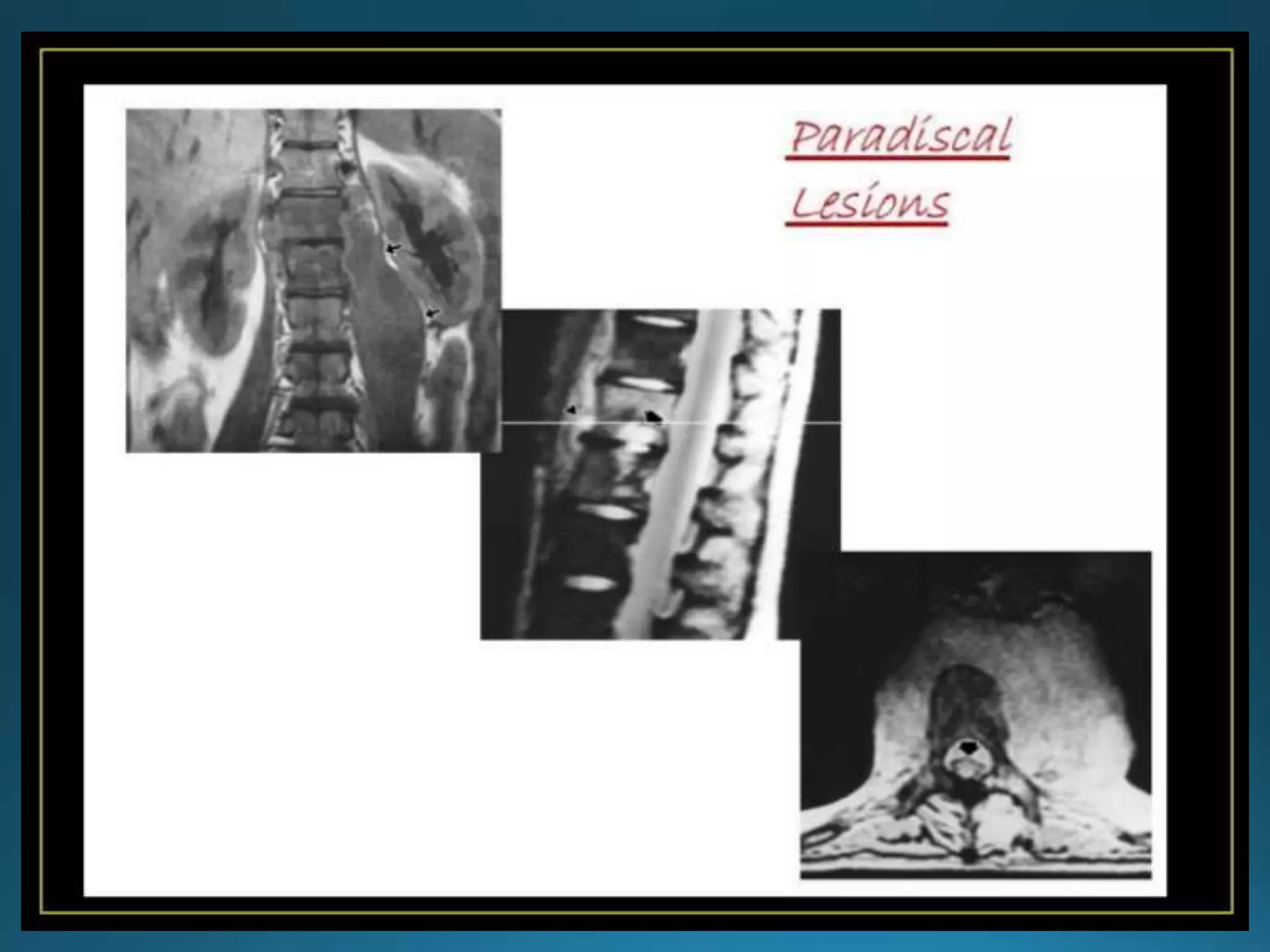 Tb spine | PPTX