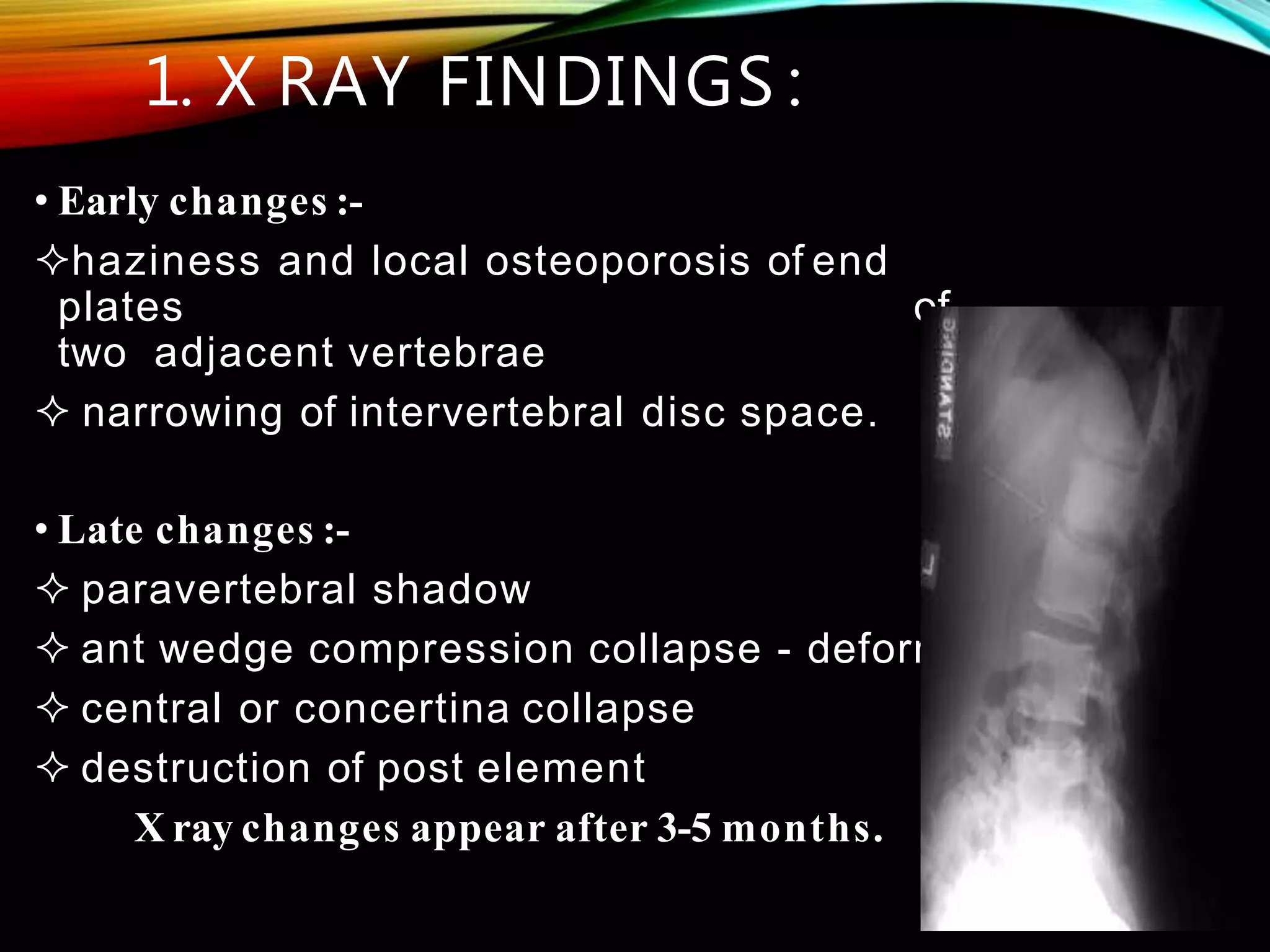 Tb spine | PPTX