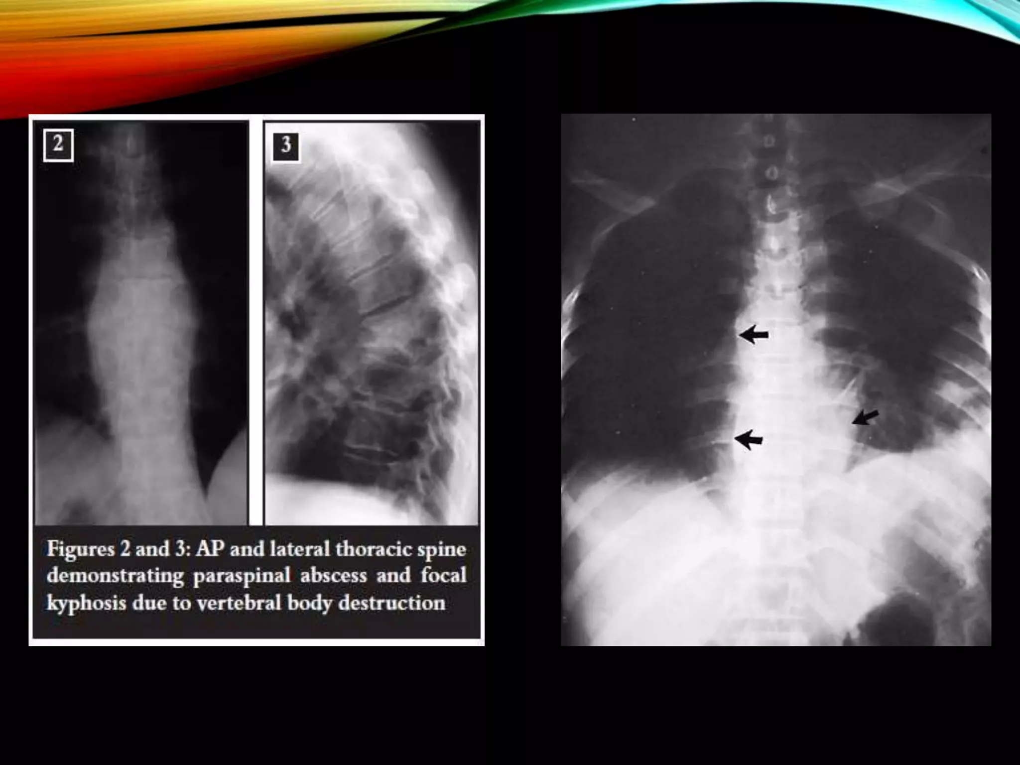 Tb spine | PPTX
