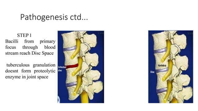 TB SPINE.pptx | Bone and Joint Conditions | Diseases and Conditions
