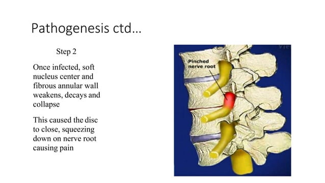TB SPINE.pptx | Bone and Joint Conditions | Diseases and Conditions