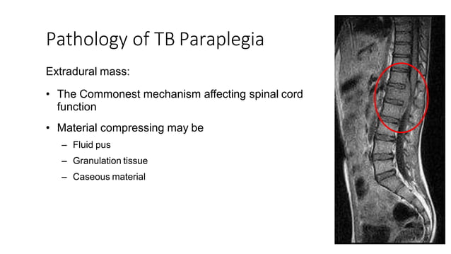 TB SPINE.pptx | Bone and Joint Conditions | Diseases and Conditions