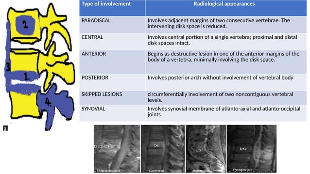 TB spine.pptx23467899678888888899999000000 | PPT