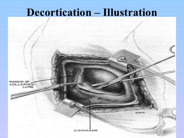 Pleuro-Pulmonary Tuberculosis - Surgical Principles