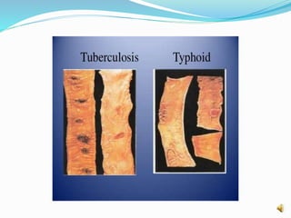 Tb,typhoid | PPTX