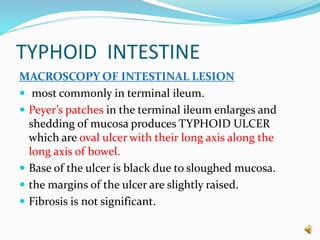 Tb,typhoid | PPTX