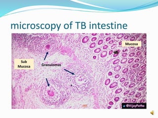 tbtyphoid-200519073256 (1).pdf