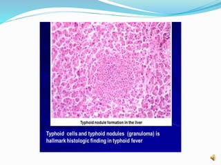 tbtyphoid-200519073256 (1).pdf