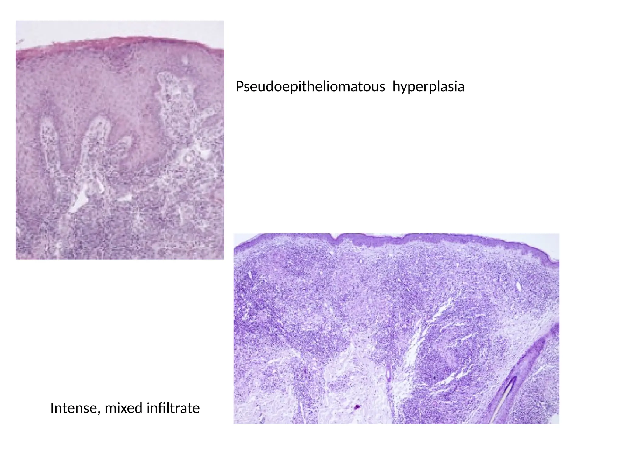 Tuberculosis verrucosa cutis a skin condition | PPT | Free Download
