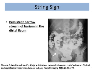 Tb vs crohns | PPT
