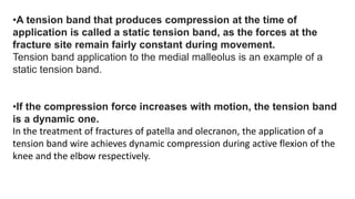 Tension Band Wiring principles and applications | PPTX