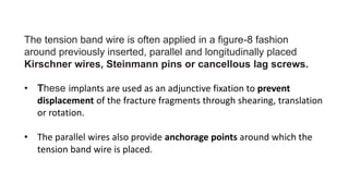 Tension Band Wiring principles and applications | PPTX