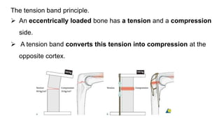 Tension Band Wiring principles and applications | PPTX