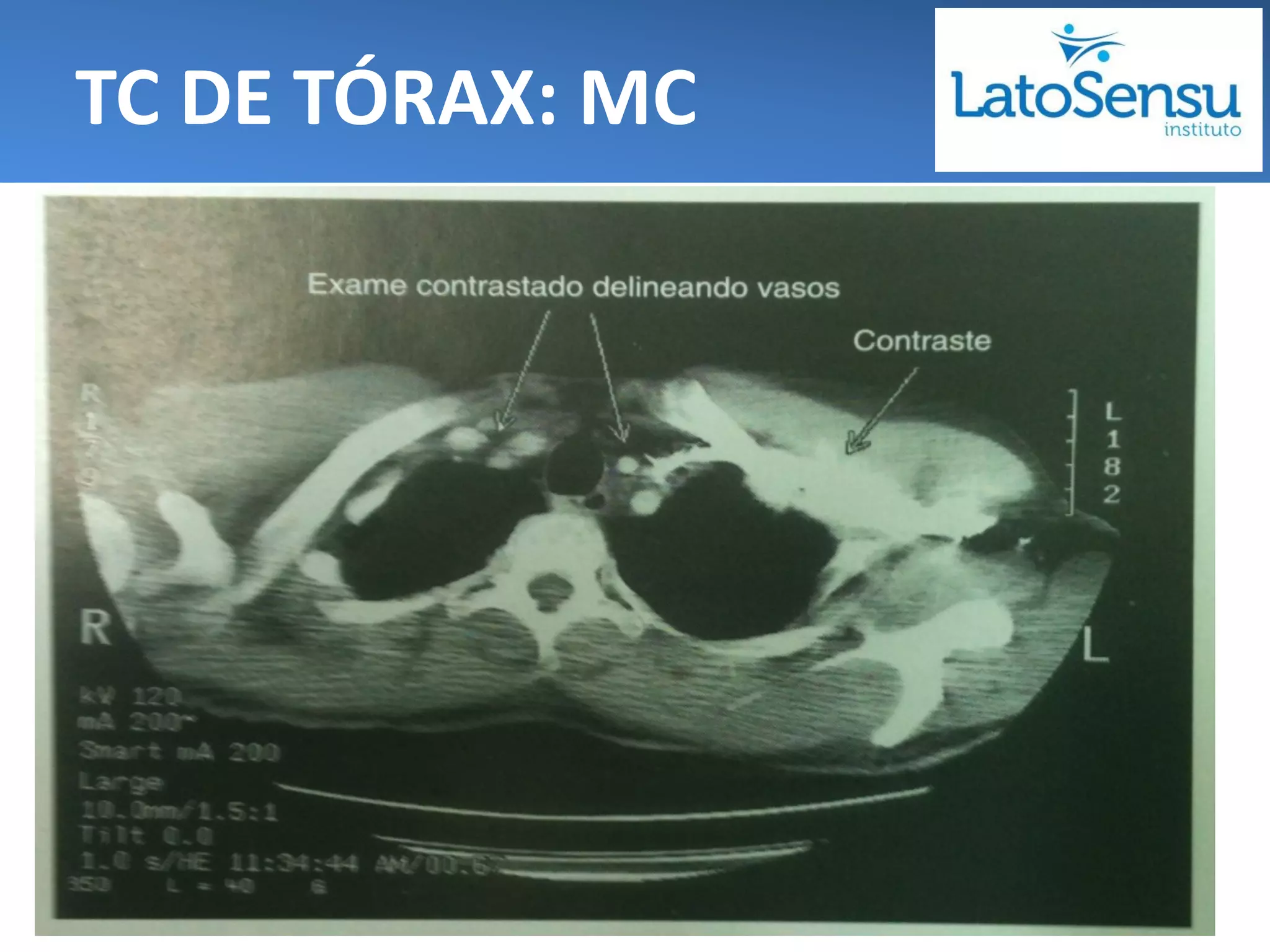 Tomografia Computadorizada: Patologias do Tórax | PDF