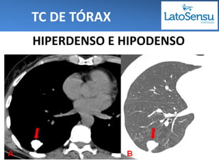 Tomografia Computadorizada: Patologias do Tórax | PPT