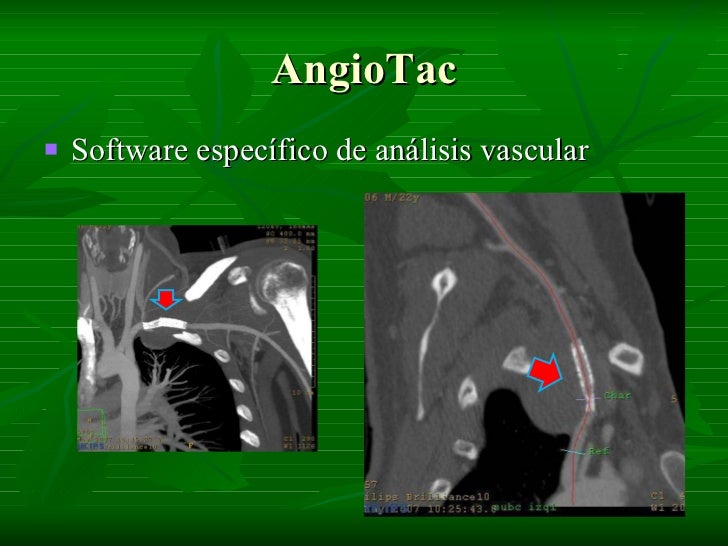 Tc angio tac