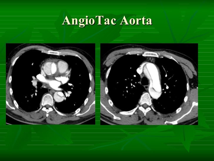 Tc angio tac