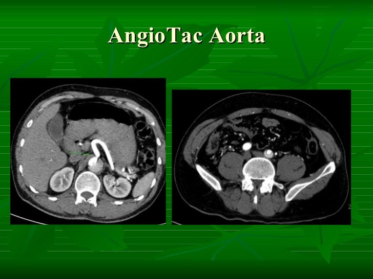 Tc angio tac